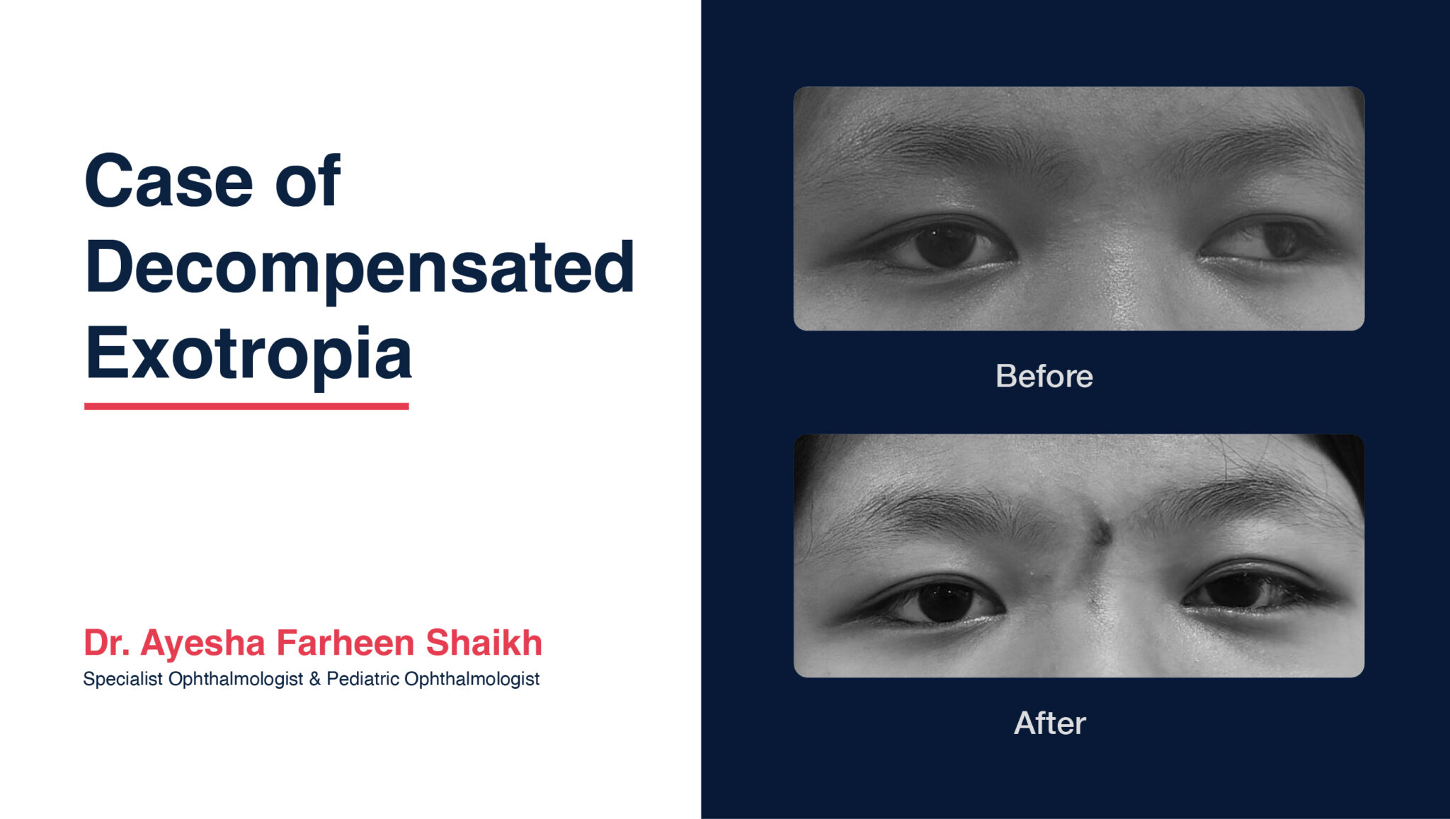 How to Fix Exotropia | Treatment of Exotropia | Medeor Hospital